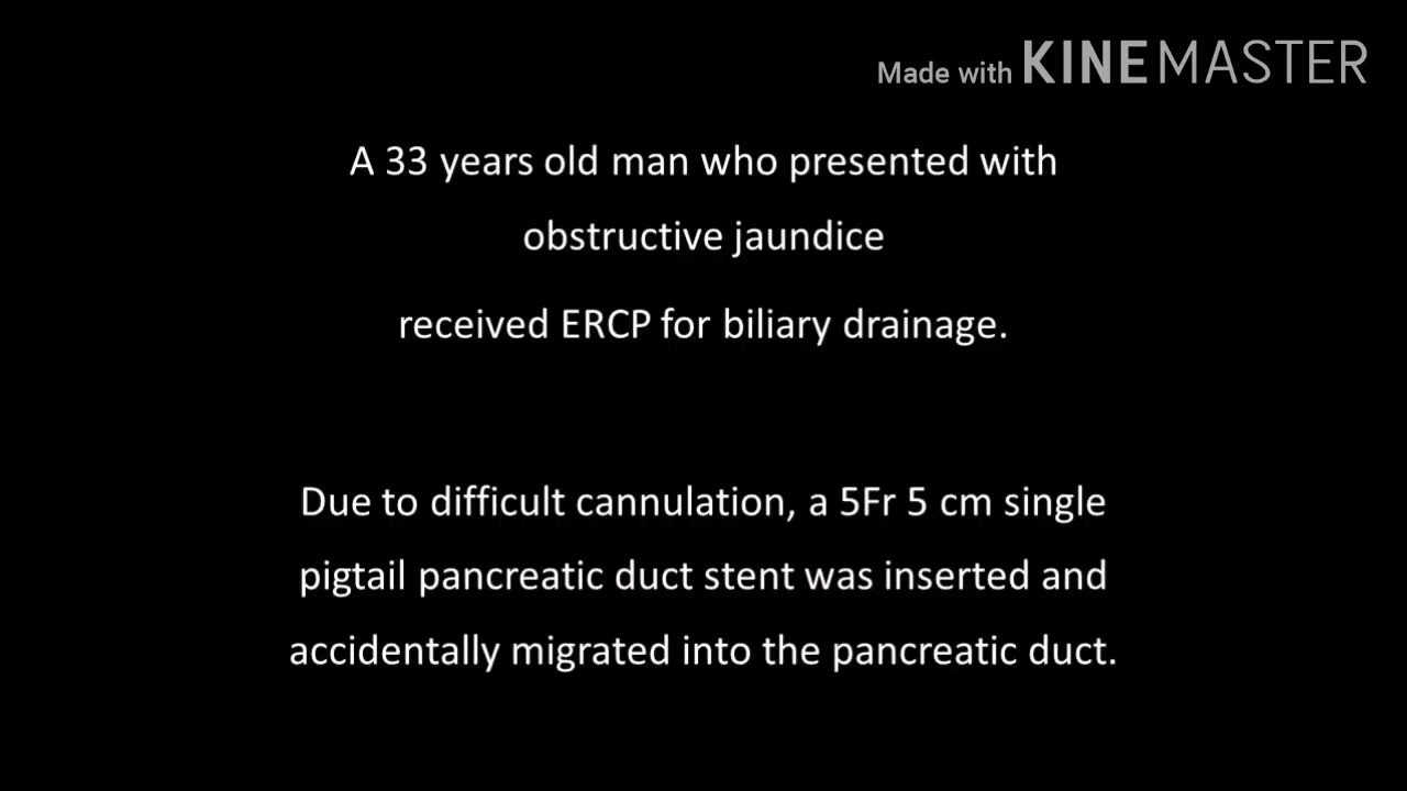 ERP : Endoscopic Removal of Migrated PD Stent - TWFC - YouTube
