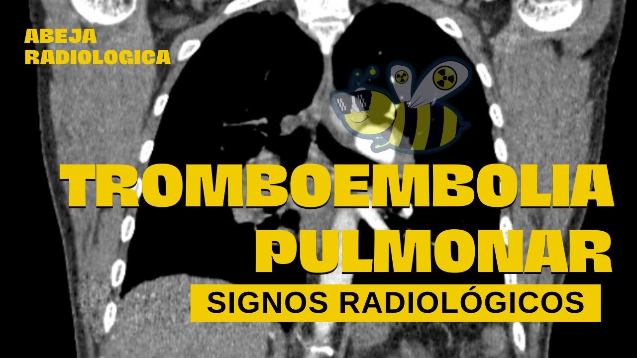🔵🟡Signos radiológicos en tromboembolia pulmonar🔵🟡 - YouTube