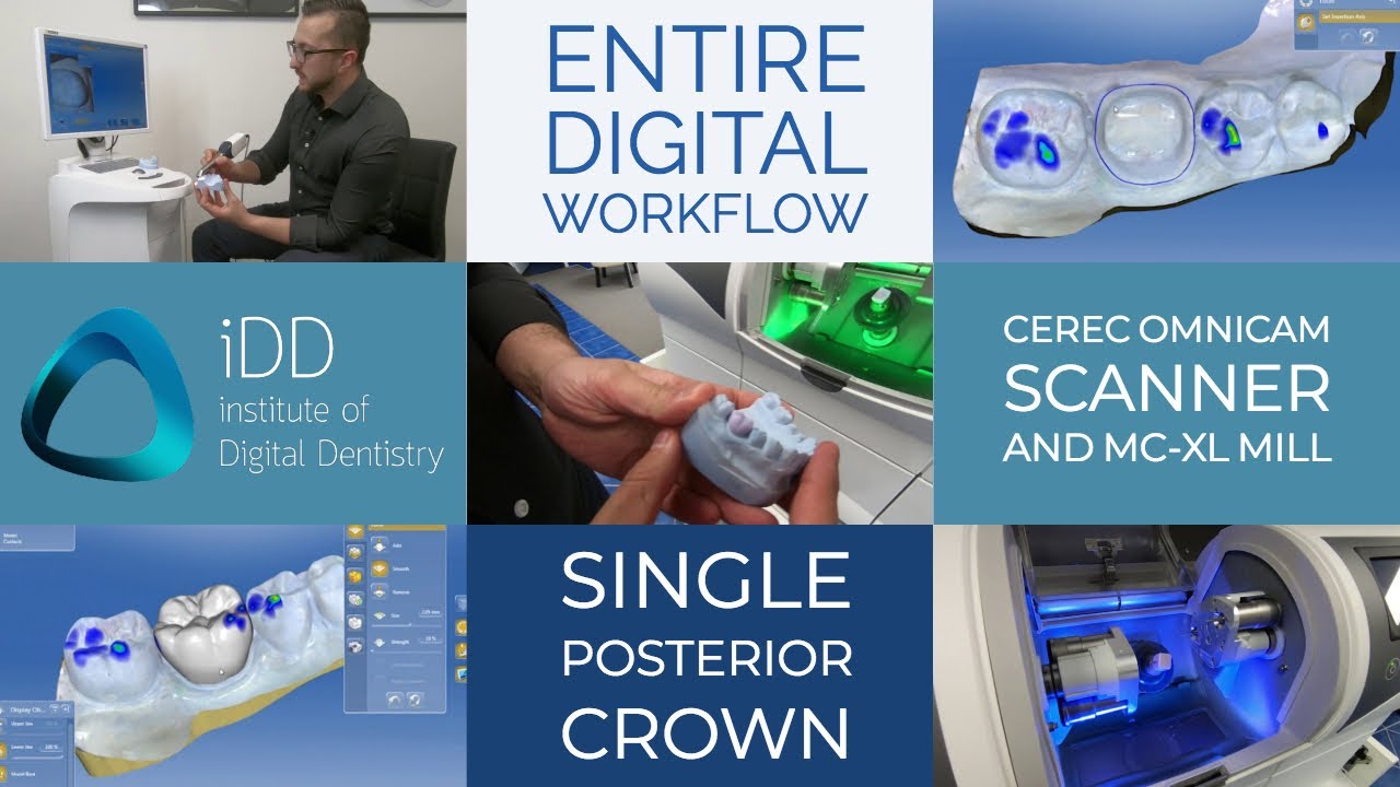 Entire Digital Workflow for CEREC Omnicam Scanner and MC XL Mill for a ...