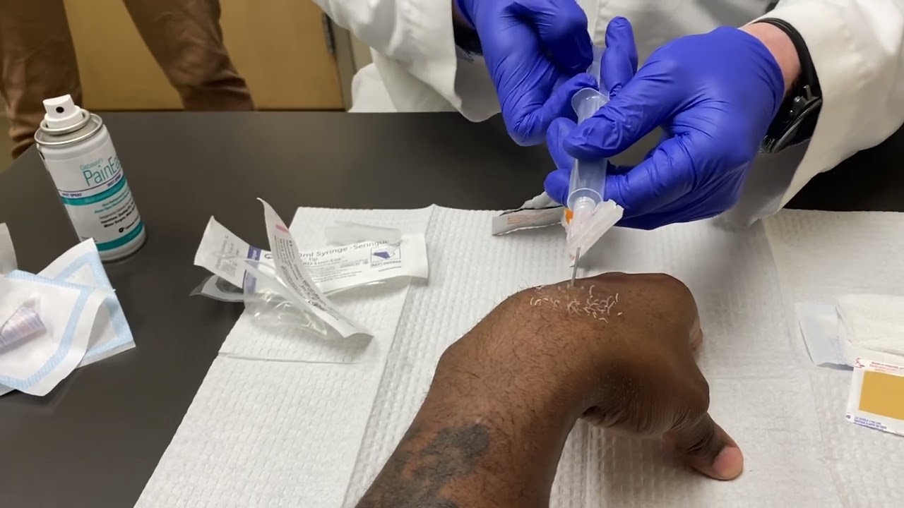 Ganglion Cyst Needle Aspiration (4/27/22) - YouTube
