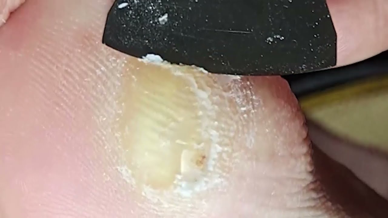 Continue to rub out foot calluses and dig out hard objects - YouTube