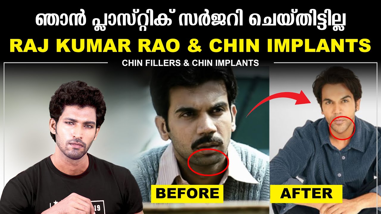 Chin Implant ചെയ്ത് ബോളിവുഡ് നടൻ RAJKUMAR RAO | Chin Transformation ...
