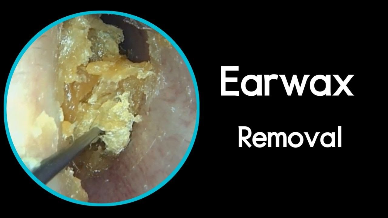 This is so Satisfying Earwax Removal for This Weekend - YouTube