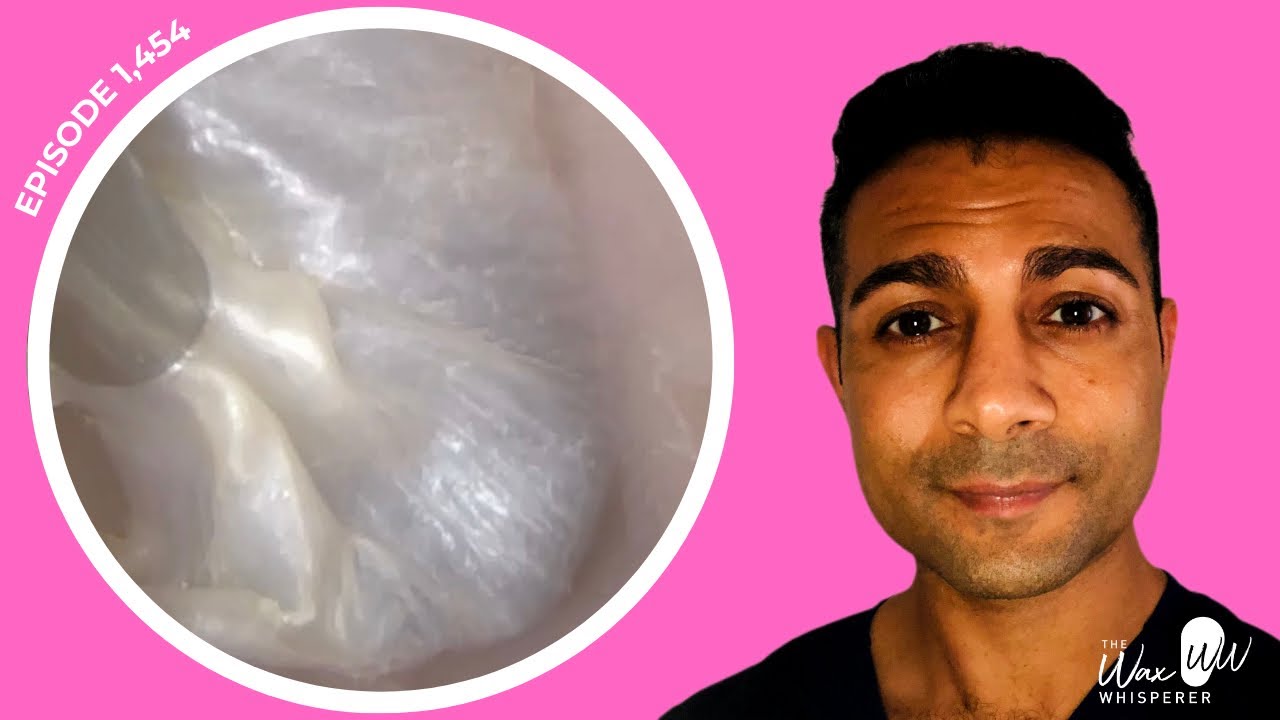 1,454 - Itchy Dead Skin Lining Ear Canal Peeled Away to Help Patient ...