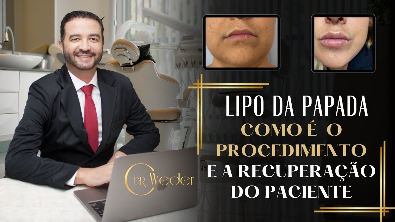 Lipo Laser da Papada: Saiba como é feita, como é a recuperação e ...