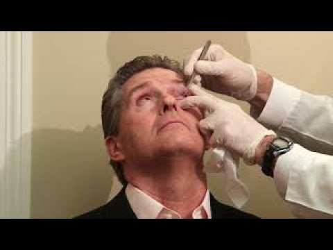 PROKERA® Insertion and Removal - YouTube