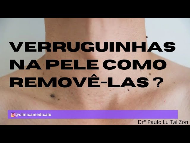 Verrugas No Pescoco Acrocórdons E Verrugas São Lesões De Pele Muito