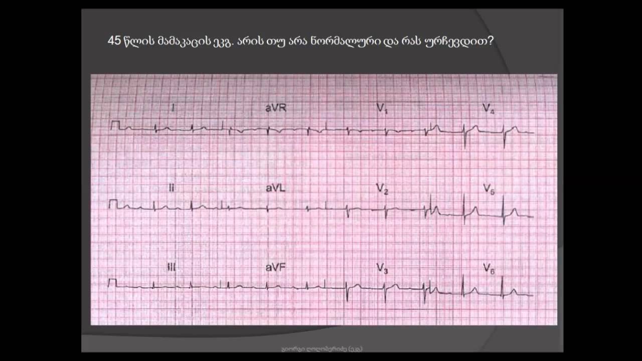 ეკგ გარჩევა I ხარისხის ატრიოვენტრიკულური ბლოკადა Av ბლოკადა Youtube