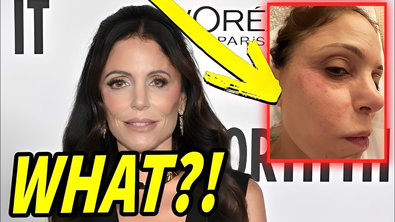 Bethenny Frankel Contracts Bacterial Infection on Face in St. Barths ...