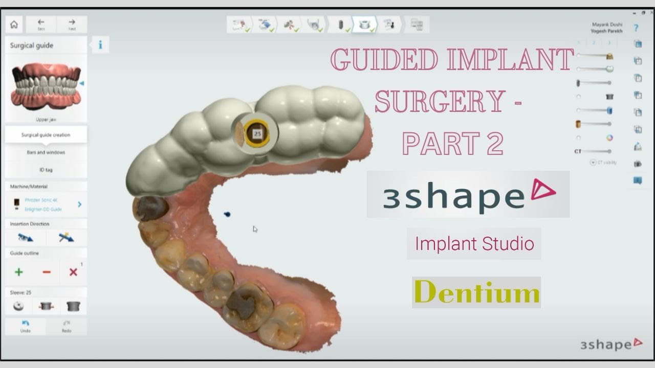 Live Fully Guided Implant Surgery using Dentium Fully Guided kit & 3Shape Implant Studio Part 2 ...