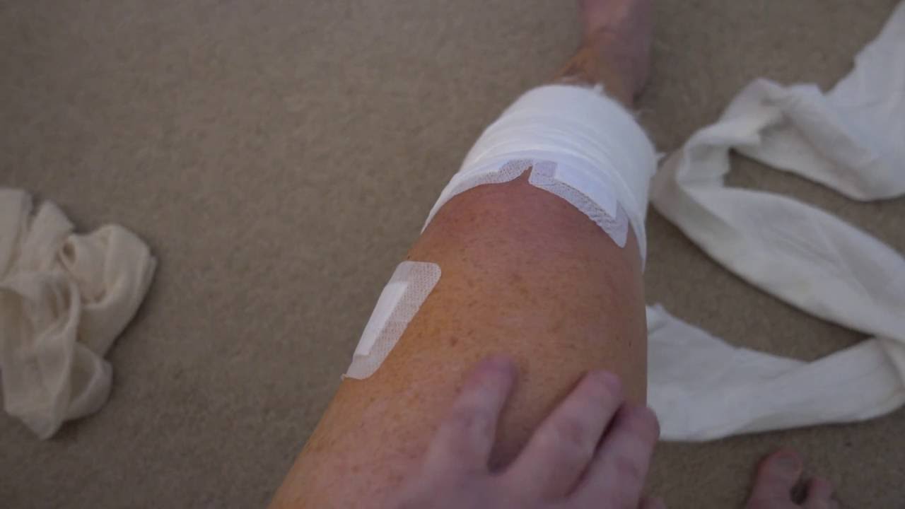 ACL Knee Surgery Unboxing - YouTube