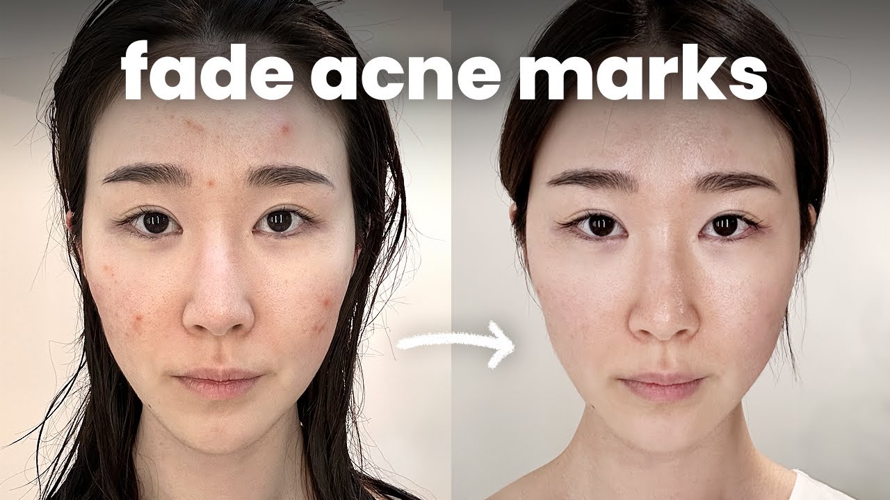 How I Fade Acne Marks Fast (Acne Scars & Hyperpigmentation) - YouTube