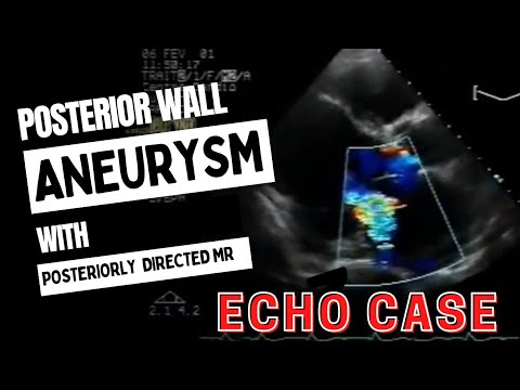 Posterior wall aneurysm and MR with Posteriorly directed jet - YouTube