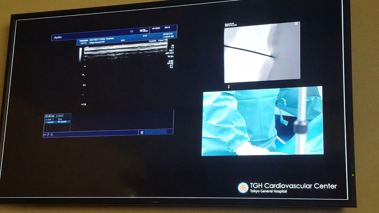 Distal Transradial puncture - YouTube