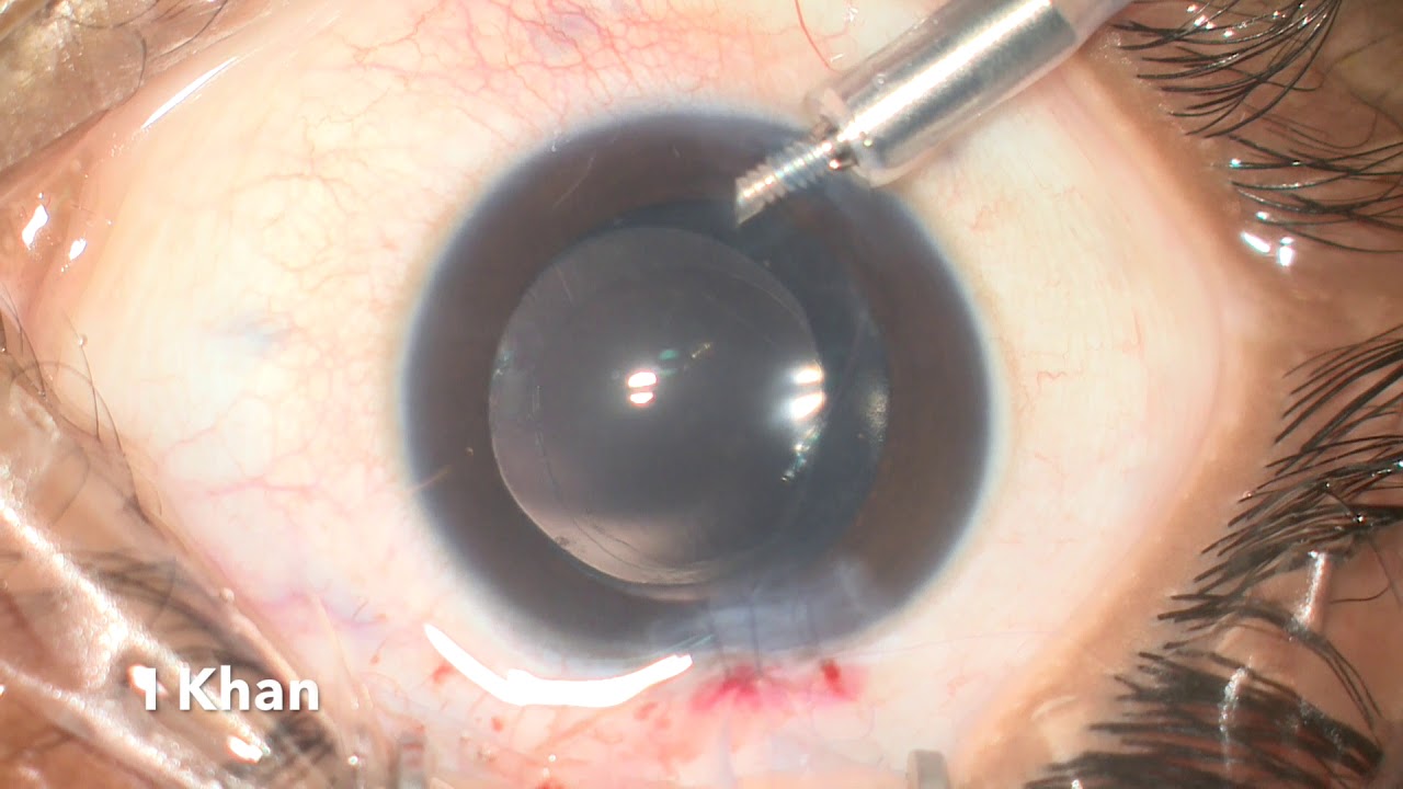 Pediatric Lensectomy IOL and Posterior Vitreo Rhexis - YouTube