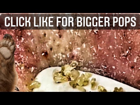 Extraction Compilation! Pimple Blackhead Comedones - YouTube