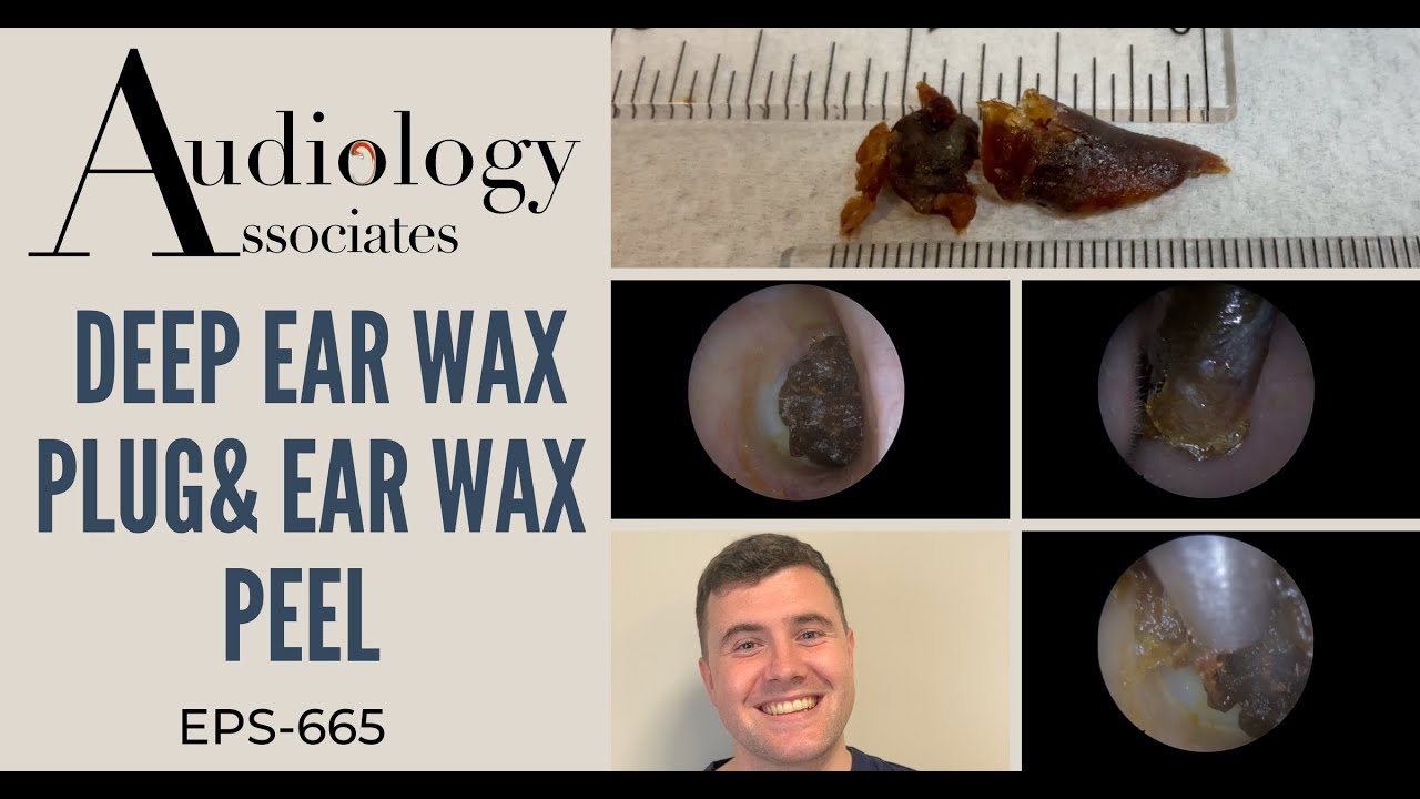 DEEP EAR WAX PLUG & EAR WAX PEEL - EP665 - YouTube