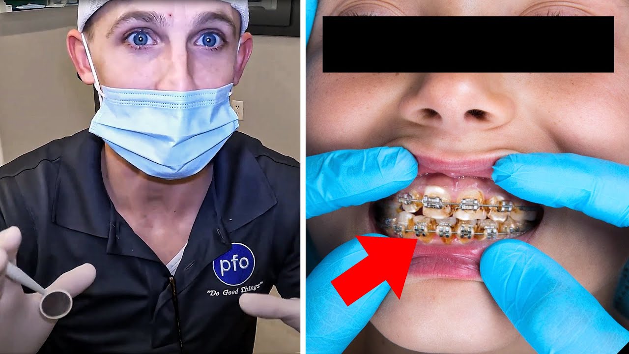 Do Braces Cause CAVITIES? the truth…. Orthodontist explains - YouTube