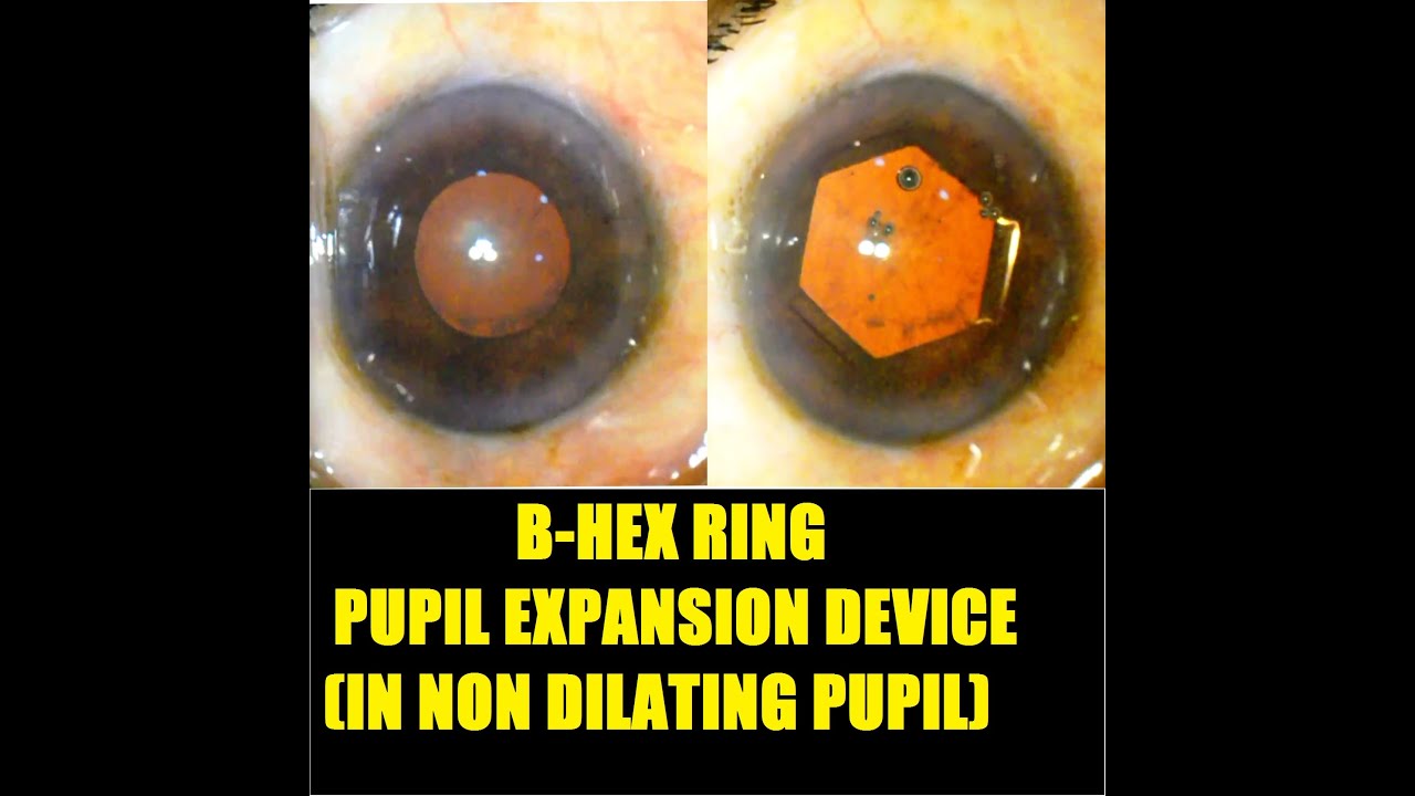 B HEX RING (PUPIL EXPANSION DEVICE FOR NON DILATING PUPIL) - YouTube