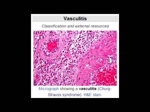 Lab or Diagnostic Findings: Vasculitis (Wegener's, Microscopic ...