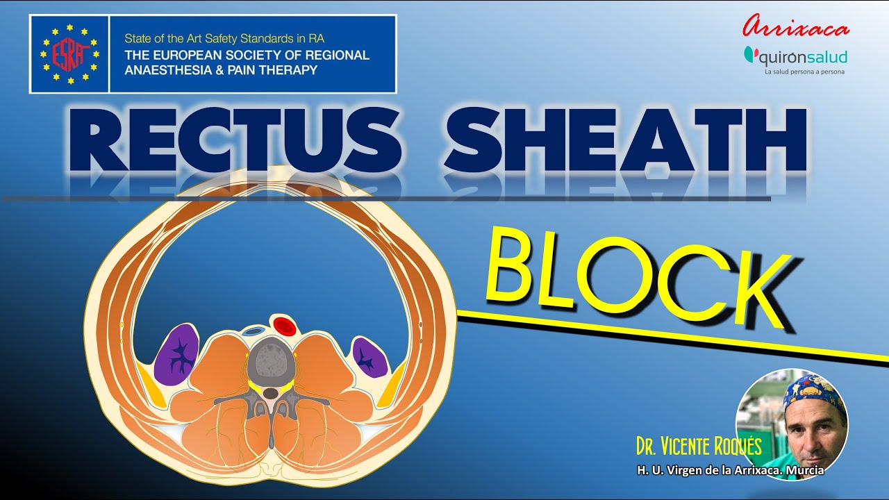 ALL YOU NEED TO KNOW ABOUT RECTUS SHEATH BLOCK - YouTube