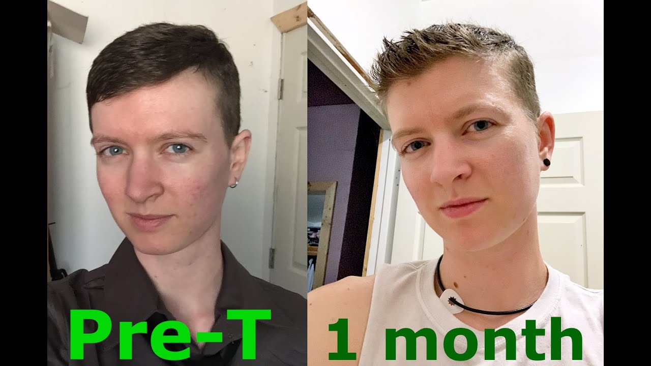 Adult FTM: Month 1 on T (with Closed Captions Subtitles in English ...