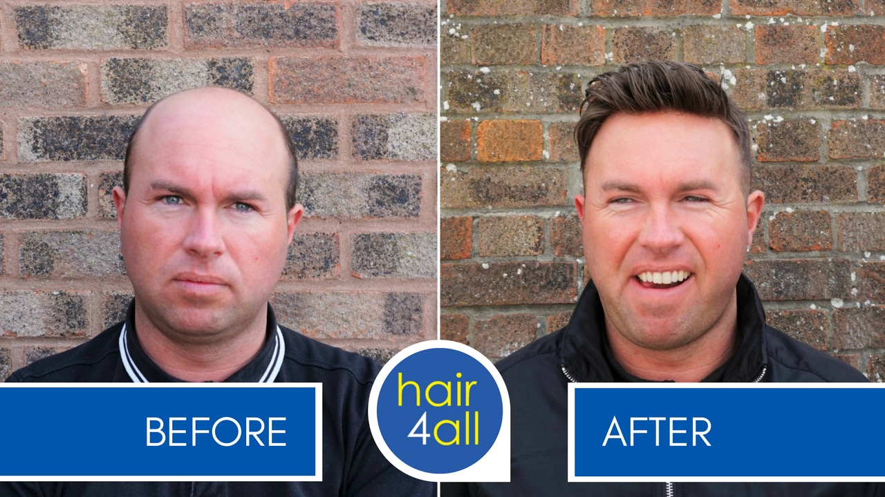 How to Apply (Attach) a Non-Surgical Hair Replacement System for Men ...