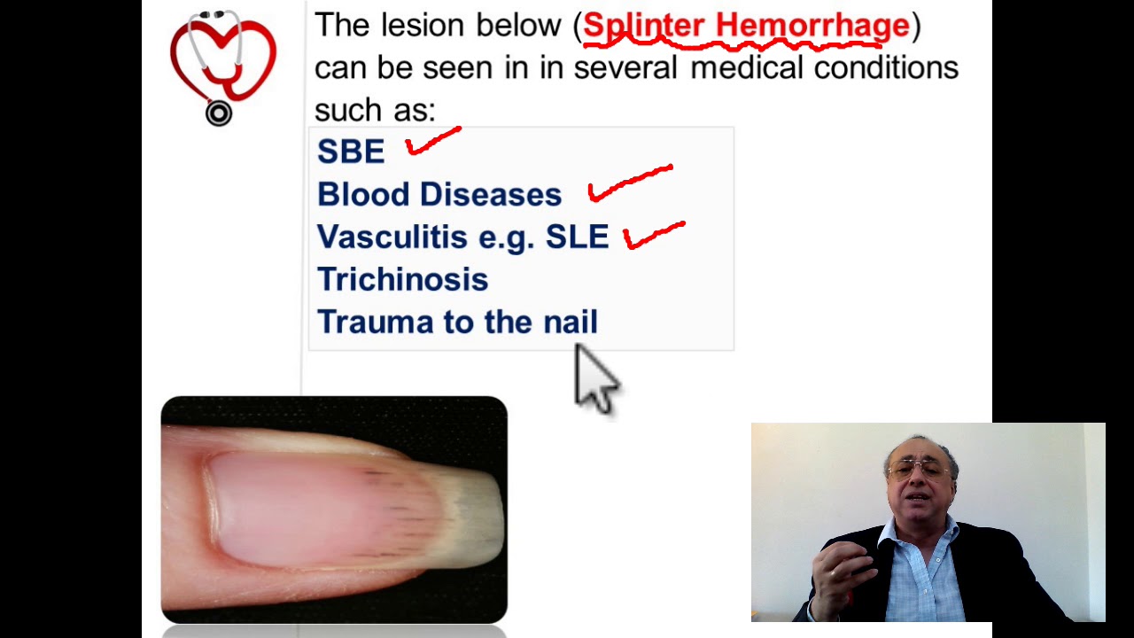 Splinter hemorrhage #cme #internal_medicine #medical #usmle # ...