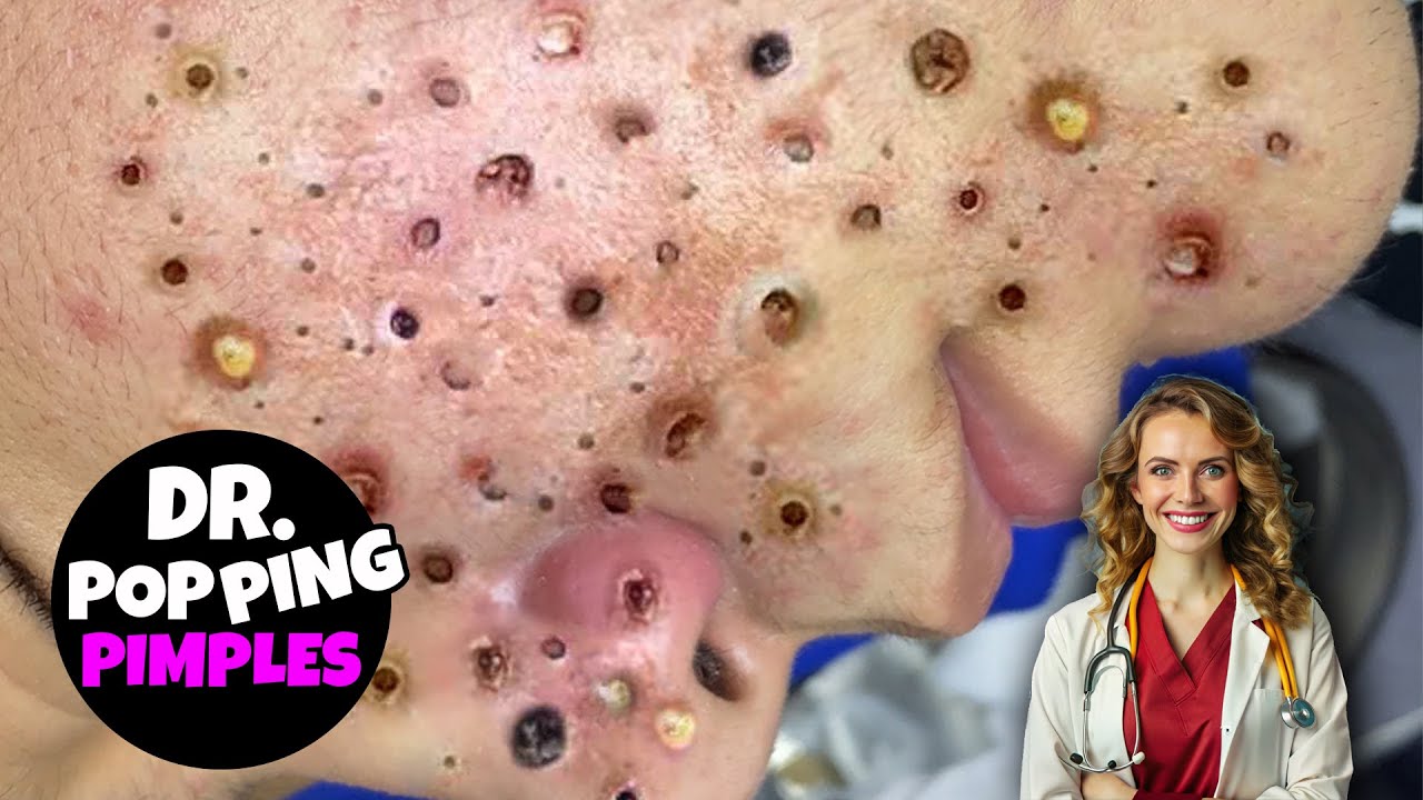 Popping Pimples And Blackheads - 185 - YouTube