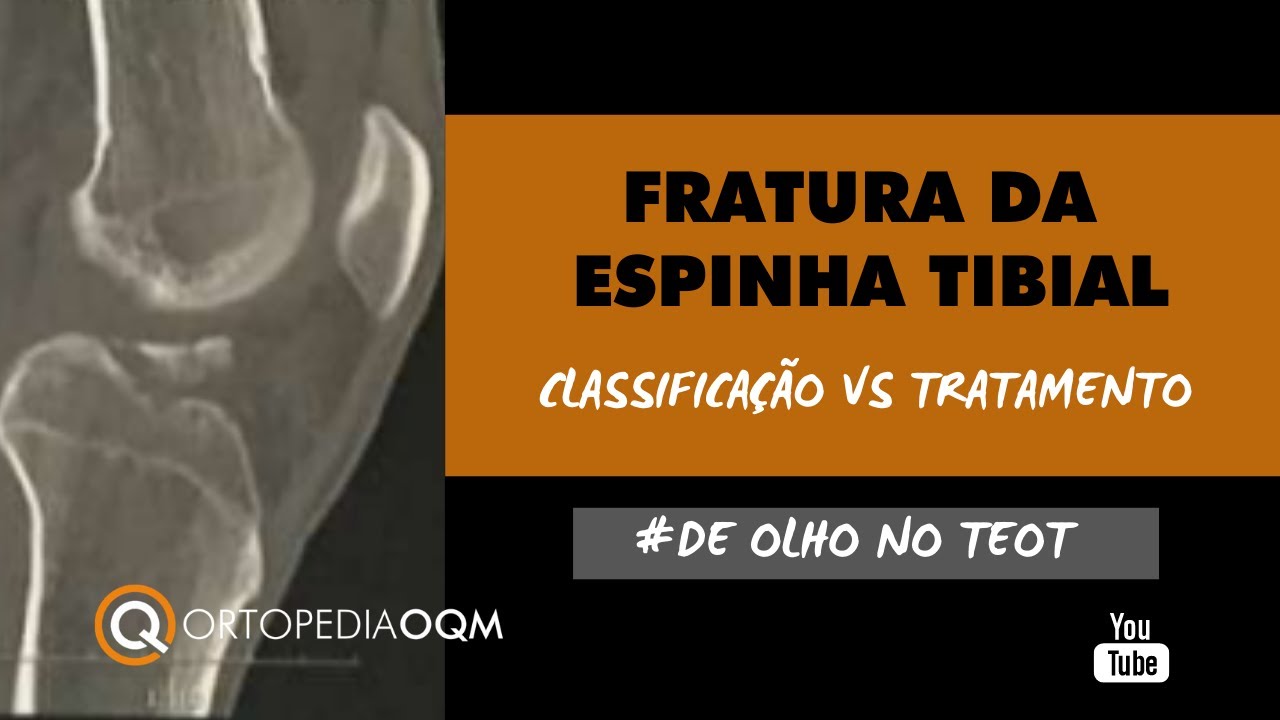 Fratura da Espinha da Tíbia! Classificação e tratamento 👊🏻 De olho no ...