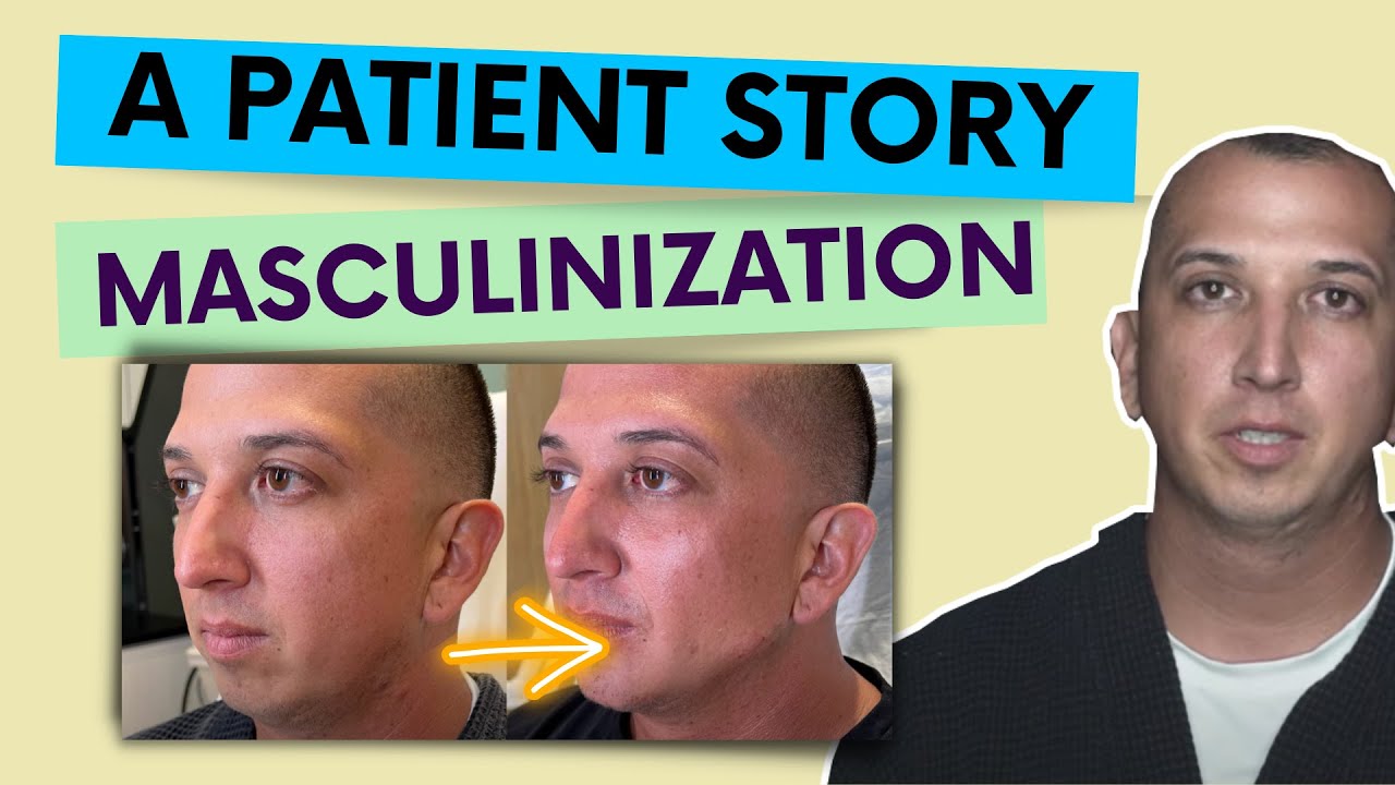 MALE FACIAL MASCULINIZATION | THE CHIN IS IN | A PATIENT STORY | Dr ...