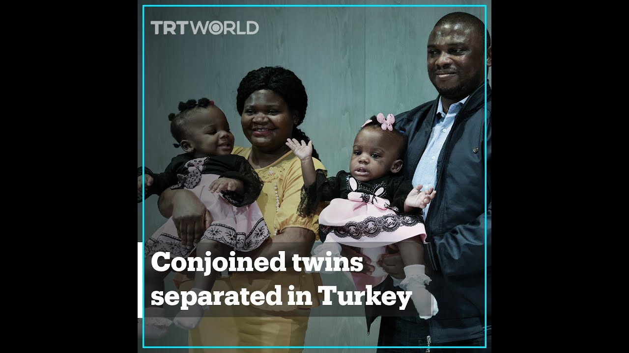 Twins conjoined at hip separated after 27-hour surgery - YouTube