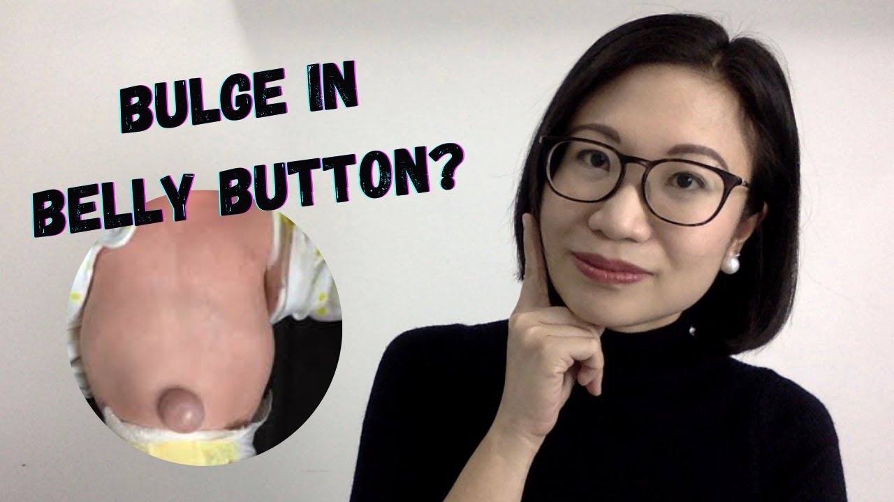 Umbilical Hernia: Worried about a bulge in baby's belly button and What ...