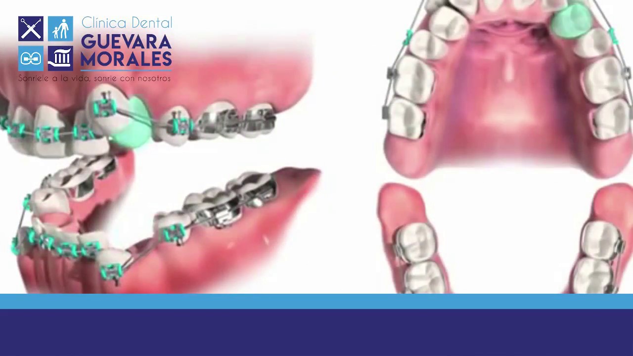 Extraccion de Premolares con Fines Ortodonticos - YouTube