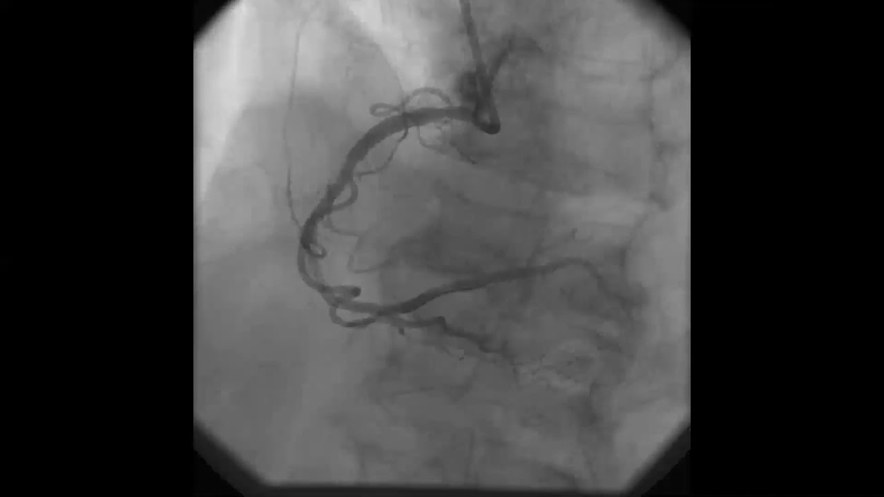Acute vessel closure: differential diagnosis- Tarek Helmy, MD - YouTube