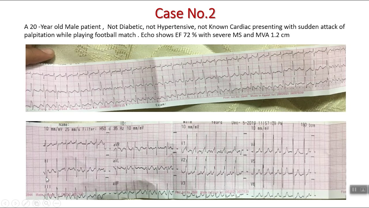 Arrhythmia practice session - Dr Ahmed Eldamaty - YouTube