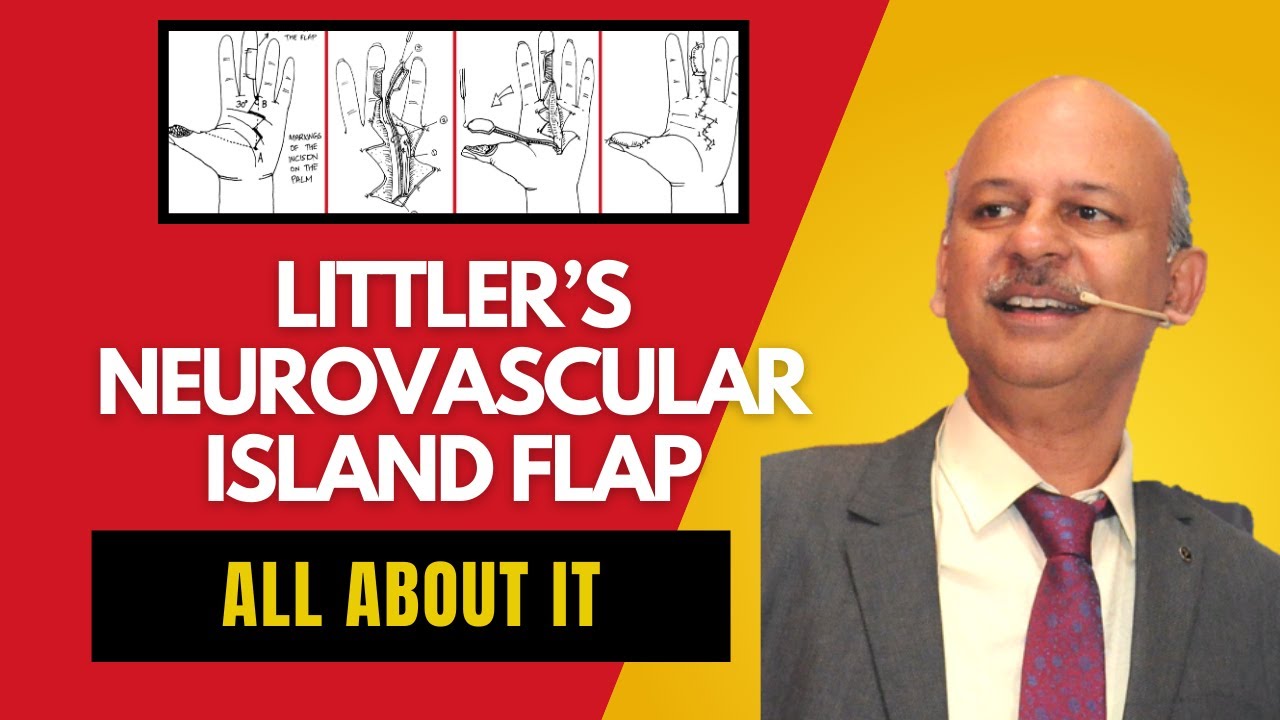 Littler's Neurovascular Island Flap for Thumb reconstruction - Surgical ...
