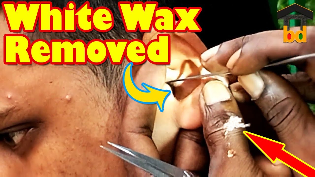 Impacted Large Wax Cleaning at the Moment / I've Got Fantastic Serve ...
