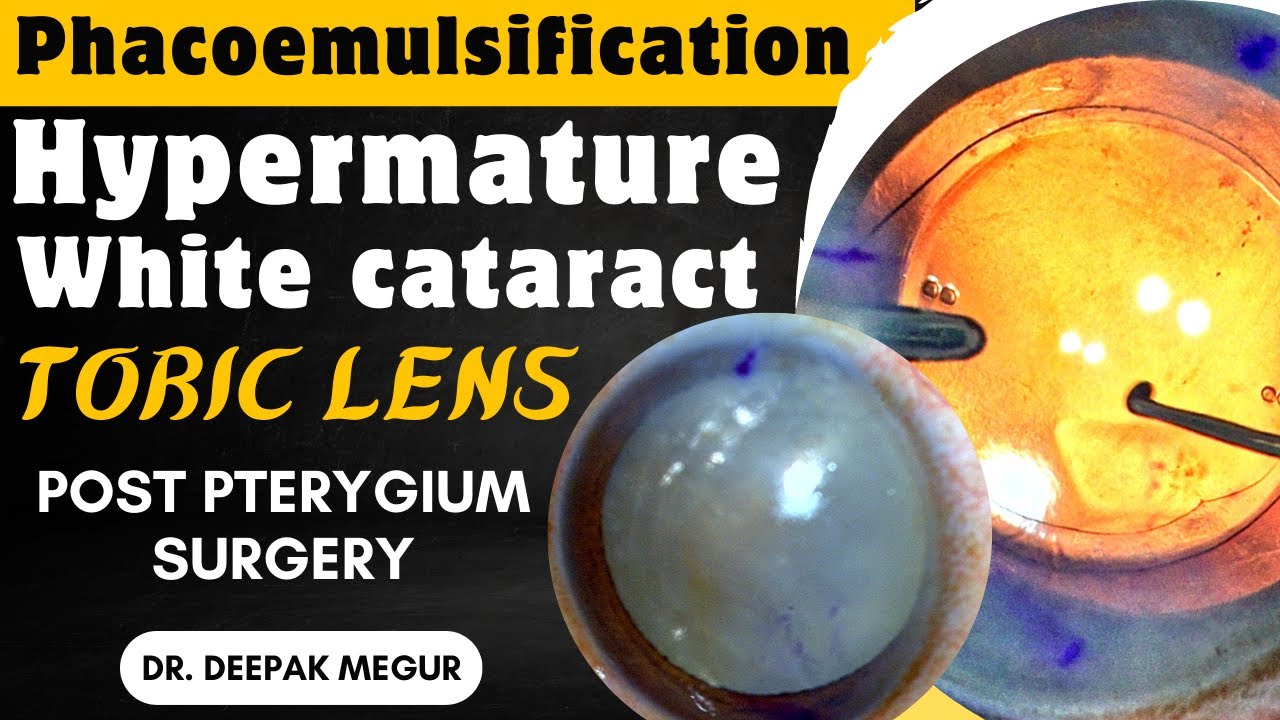 Phacoemulsification, Toric IOL, Hypermature cataract ,post pterygium ...