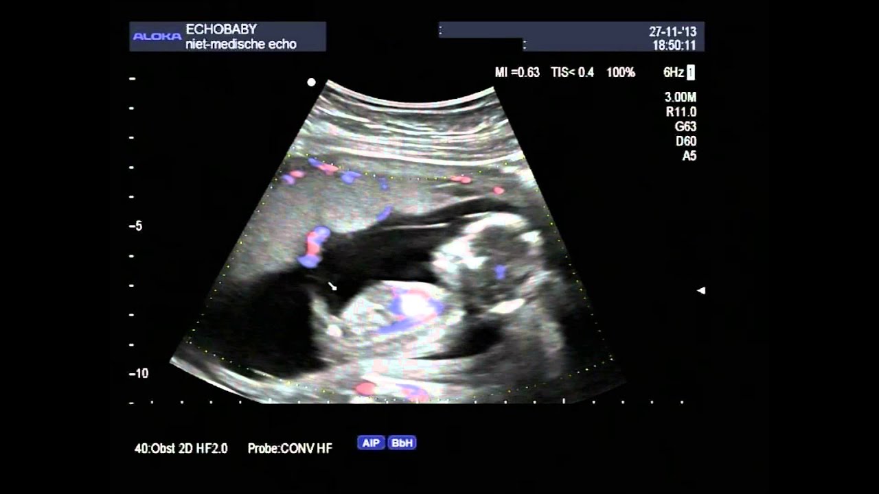 2D echo meisje 14 weken zwanger met ingesproken uitleg, kindje ademt en ...