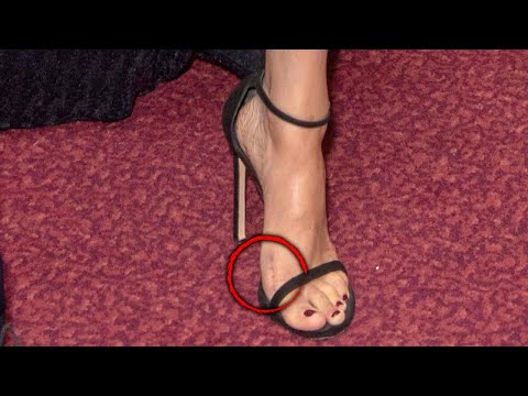 What’s That Scar on Meghan Markle’s Foot?