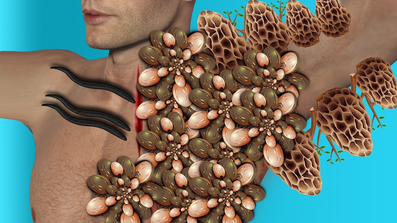 ASMR Remove Maggots & Worm Infected Armpit | Severely Injured Animation ...