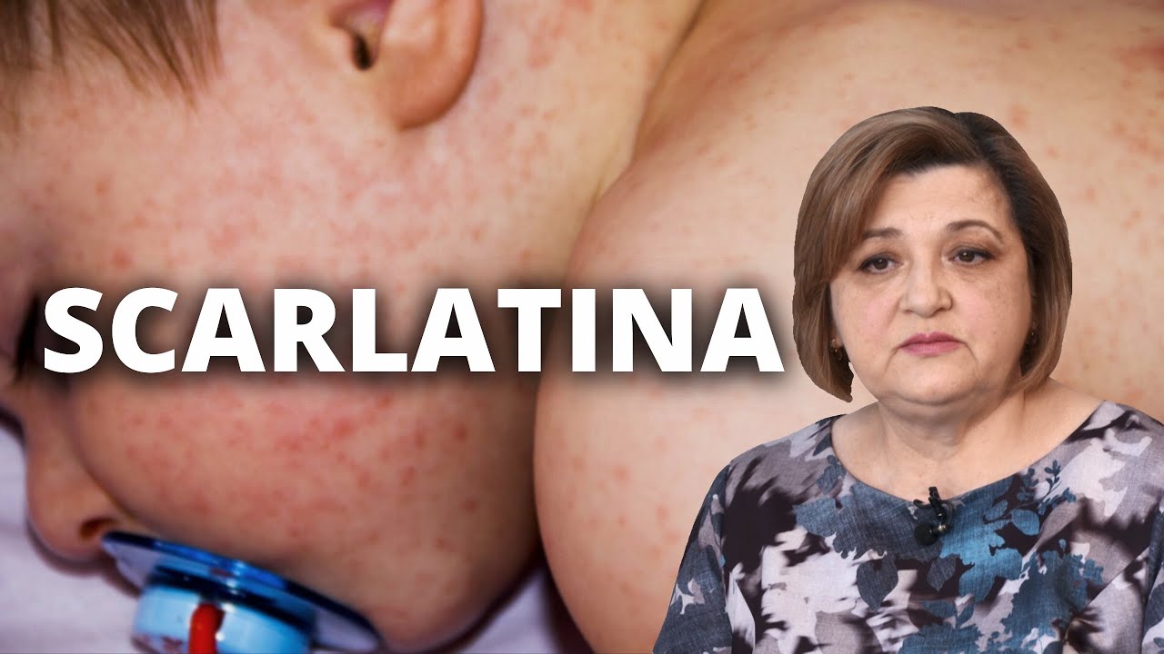 Scarlatina - stări extrem de grave, tratamentul cu antibiotice ...