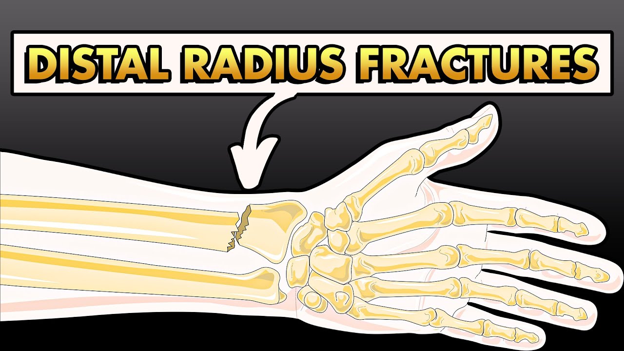 Distal Radius Fractures: Colles fracture, Smith Fracture, Barton ...