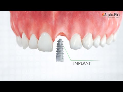 Ask Your Dentist About Dental Implants | Alpha-Bio Tec - YouTube