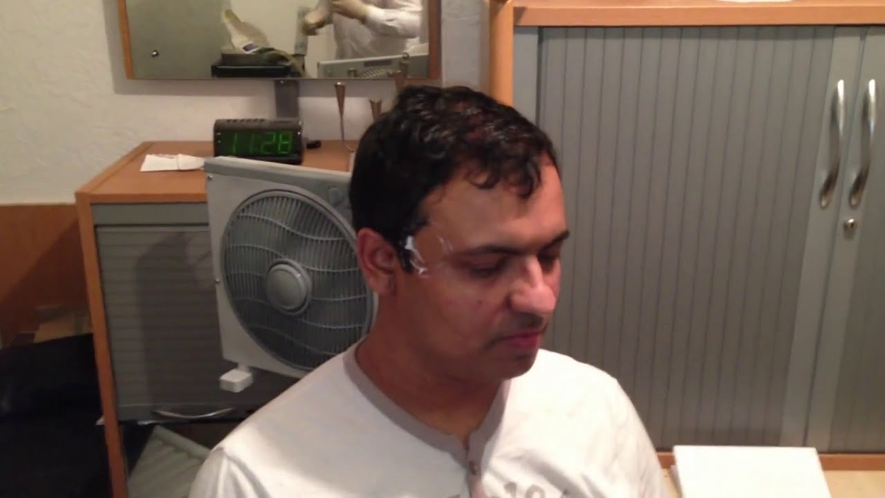 Cupping Lesson 6 الحجامه: Cupping The Side Of The Head (Temple Area ...