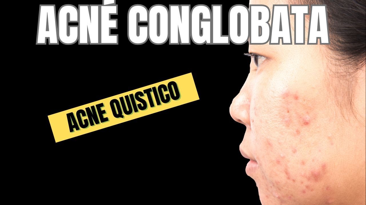 ACNE CONGLOBATA I ACNE I ACNE INFLAMATORIO I ACNE QUISTICO CAUSAS Y ...