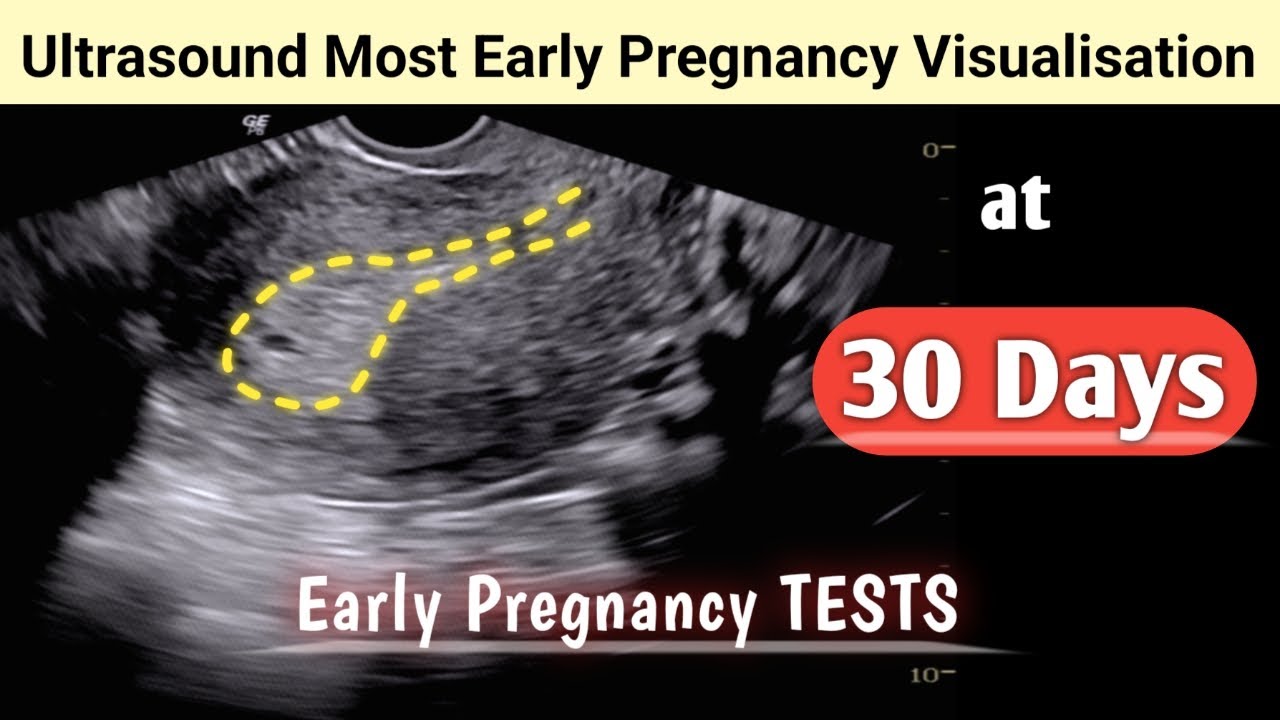 30 days most early Pregnancy Visualisation - TVS Ultrasound | Early ...