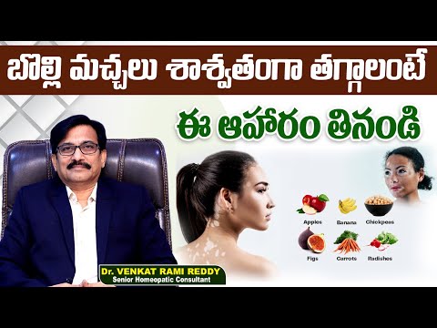 బొల్లి మచ్చలు పోవాలంటే || Best Diet for Vitiligo White Patches in Telugu || Bolli Machalu || Medi9