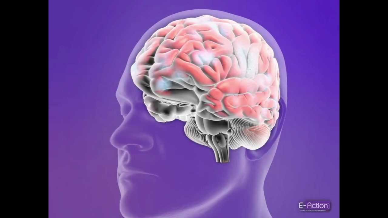E-Action Info - Tonic Clonic Seizure (Generalized Seizure) - YouTube